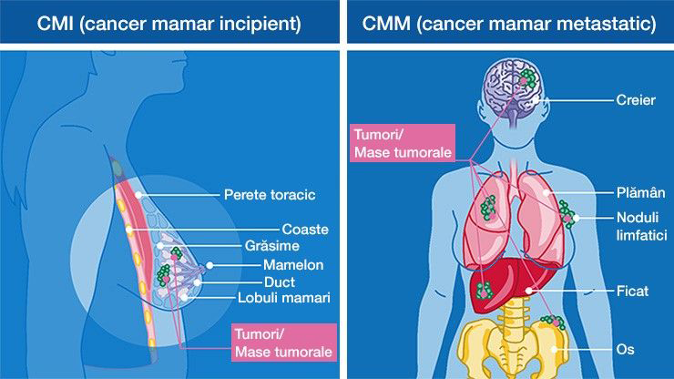 Cancerul de sân Canceruldesan